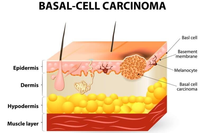 Basalioma: tutto sul tumore della pelle più comune | CUENEWS