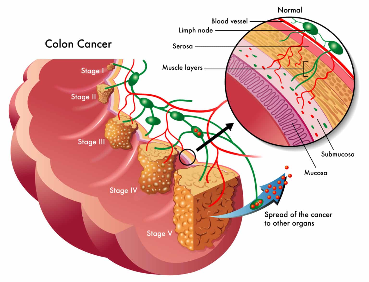 Cancro colon-retto: AI prevede la sopravvivenza nei pazienti