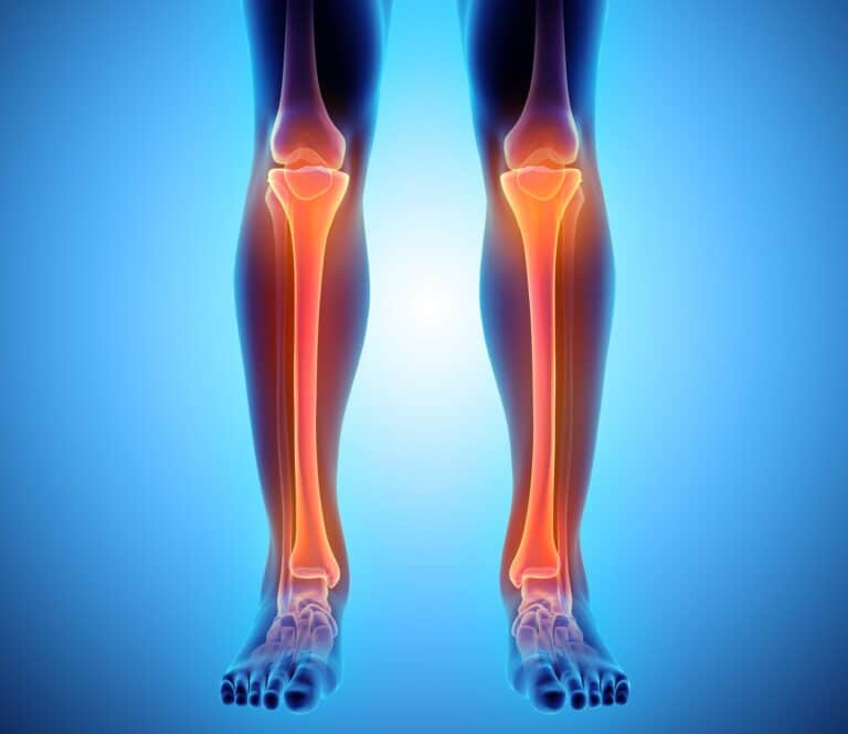 Frattura di tibia e perone: sintomi, prognosi e trattamento